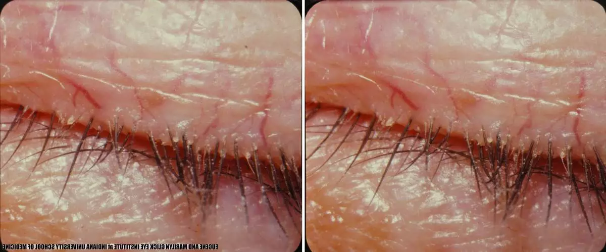 Oštećenje folikula dlake u očnom kapku.