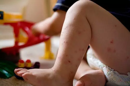 Los niños pequeños son los más afectados por las picaduras de mosquitos. Su delicada piel se inflama y se desarrolla una terrible alergia.