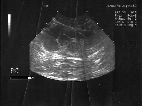 Ny ultrasound an'ny taova ao amin'ny kibo dia hanampy amin'ny famaritana cystitis amin'ny saka